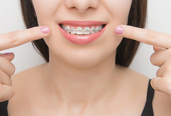 Brackets roth y mbt - Esplen Dent - Clínicas Odontológicas en Bogota